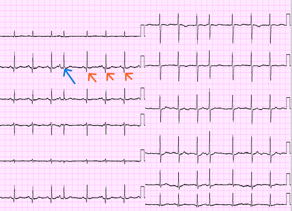 心電図問題2（SVPC） ｜ 心電図CAMP